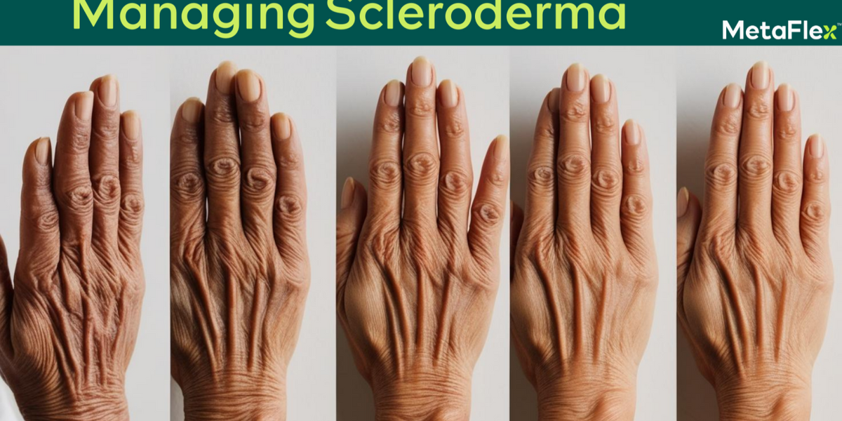 Managing Scleroderma of the Hands with the Metaflex Glove: A PDAC-Appr